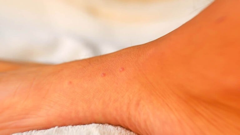 Bed Bug Bites: Pictures, Symptoms, Treatment, and Prevention
