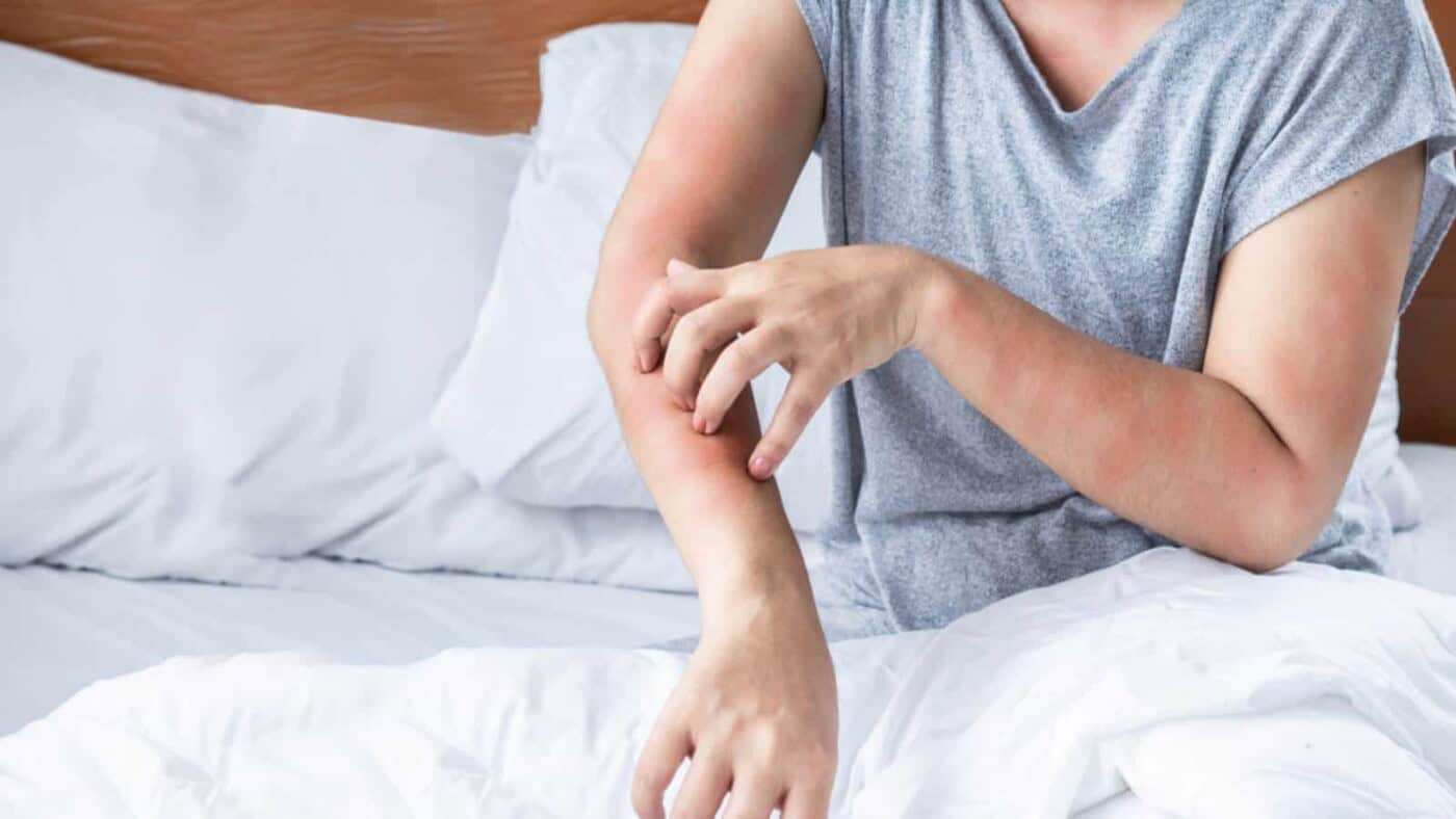 Mites: Different Types, Bites, and How to Get Rid of Them