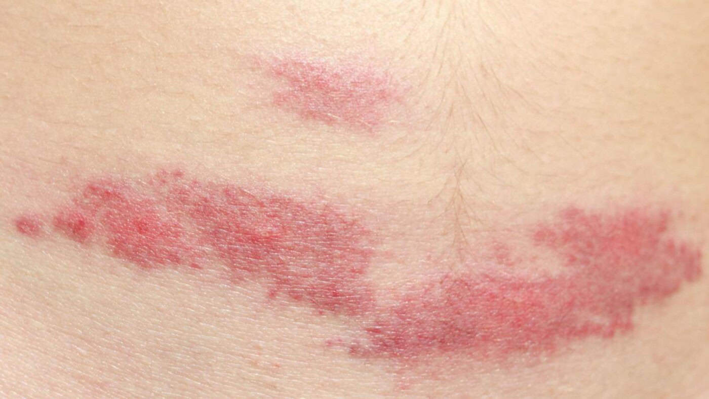 No See Ums: What They Are and How to Get Rid of Them