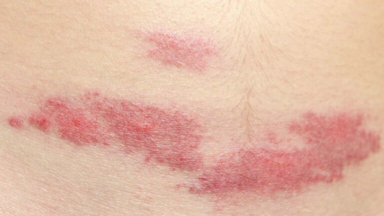 No See Ums: What They Are and How to Get Rid of Them